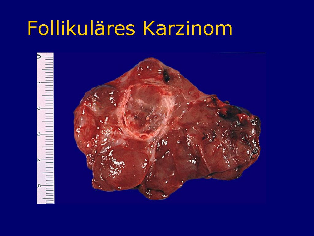 Follikuläres Karzinom